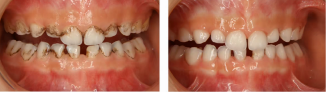 为什么刷100次牙，不如1次专业洁牙？PMTC了解一下_口腔管理_什么值得买